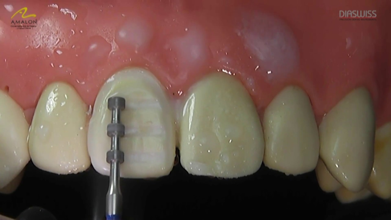 Como es el tallado para una carilla dental Paso a Paso - dentaltvweb