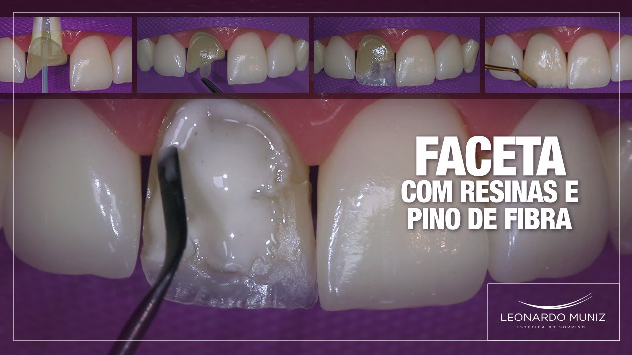 Como hacer una Carilla Directa con Composite con un Perno ( pino) de ...
